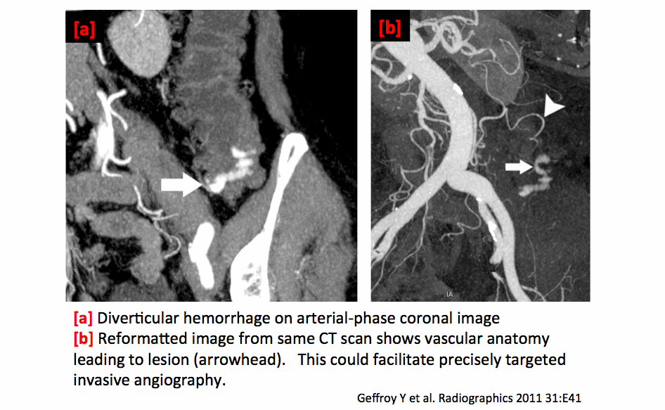CT Angiogram for evaluation of severe hematochezia