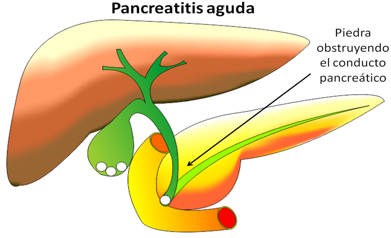 TRATAMIENTO NATURAL PANCREATITIS | EL CLUB DEL ALOE VERA