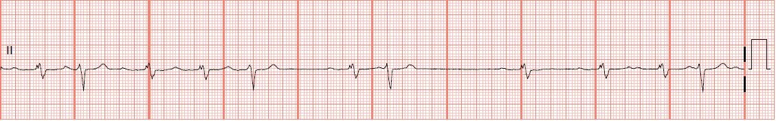 EKG Rhythm Strip Quiz 52: Heart Blocks