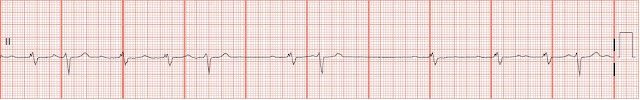 EKG Rhythm Strip Quiz 52: Heart Blocks