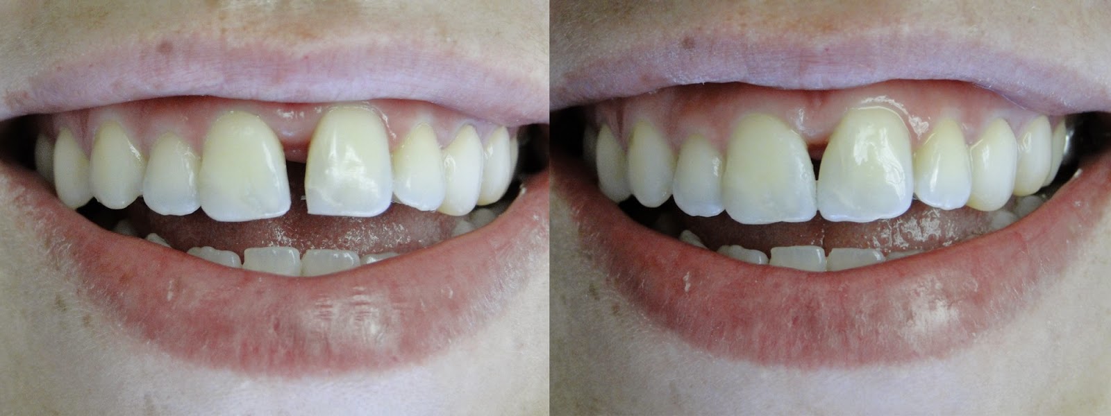 Clinica Dentaria Mais Sorriso: Diástema: charme ou problema?