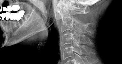 Cervical Spine X-ray Exam - RadTechOnDuty