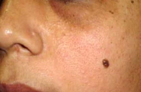 Photos of Moles on Face and Neck ~ How To Remove Moles, Warts, Skin ...