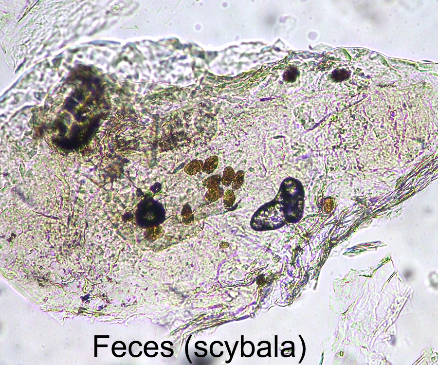Scabies Feces Under Microscope
