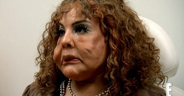 Woman's Face Becomes Horrible After Doctor Injects Her With Cement