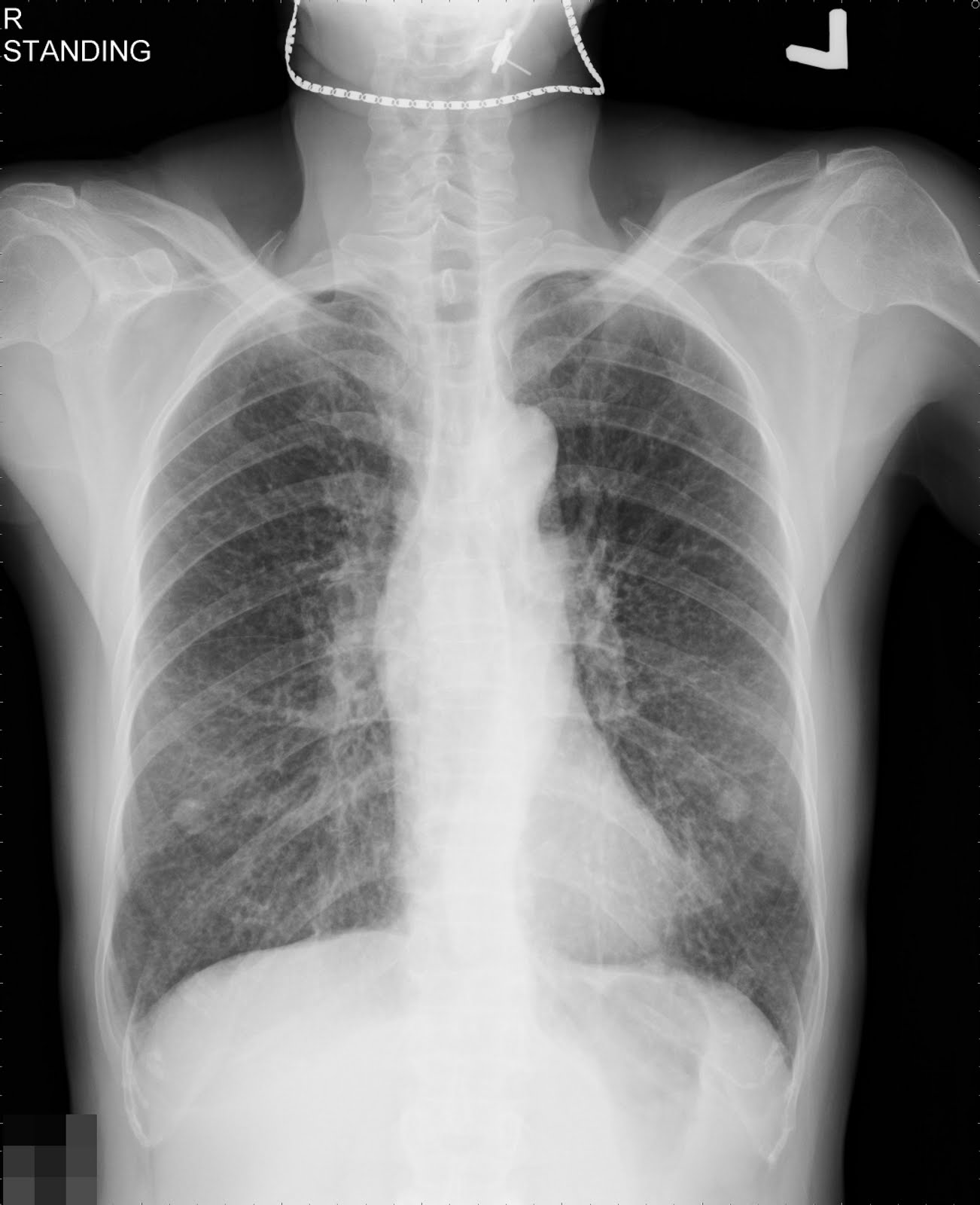 CXR 胸部x光判讀 Diffuse panbronchiolitis