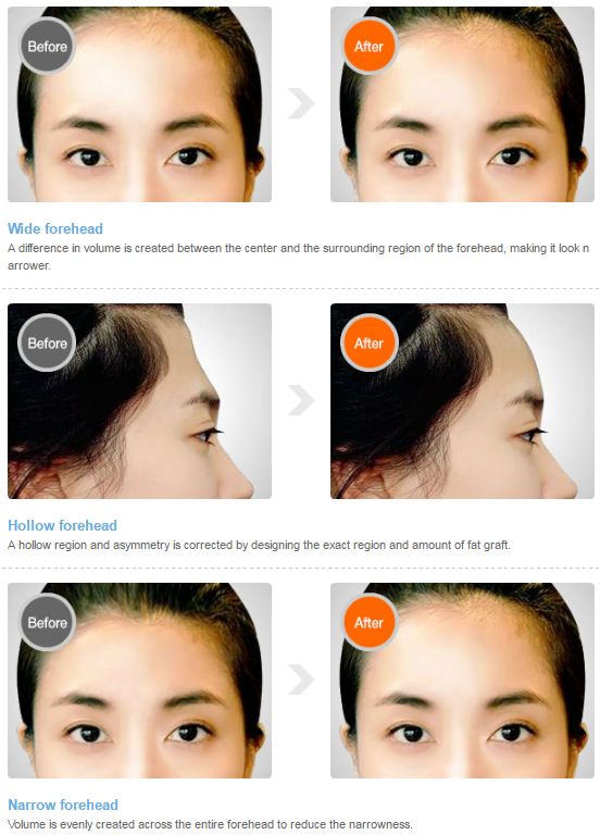 ID Hospital Korea: Do you have a 'Flat Forehead'? - forehead, forehead ...