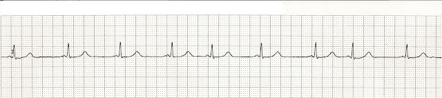 EKG Rhythm Strips 60