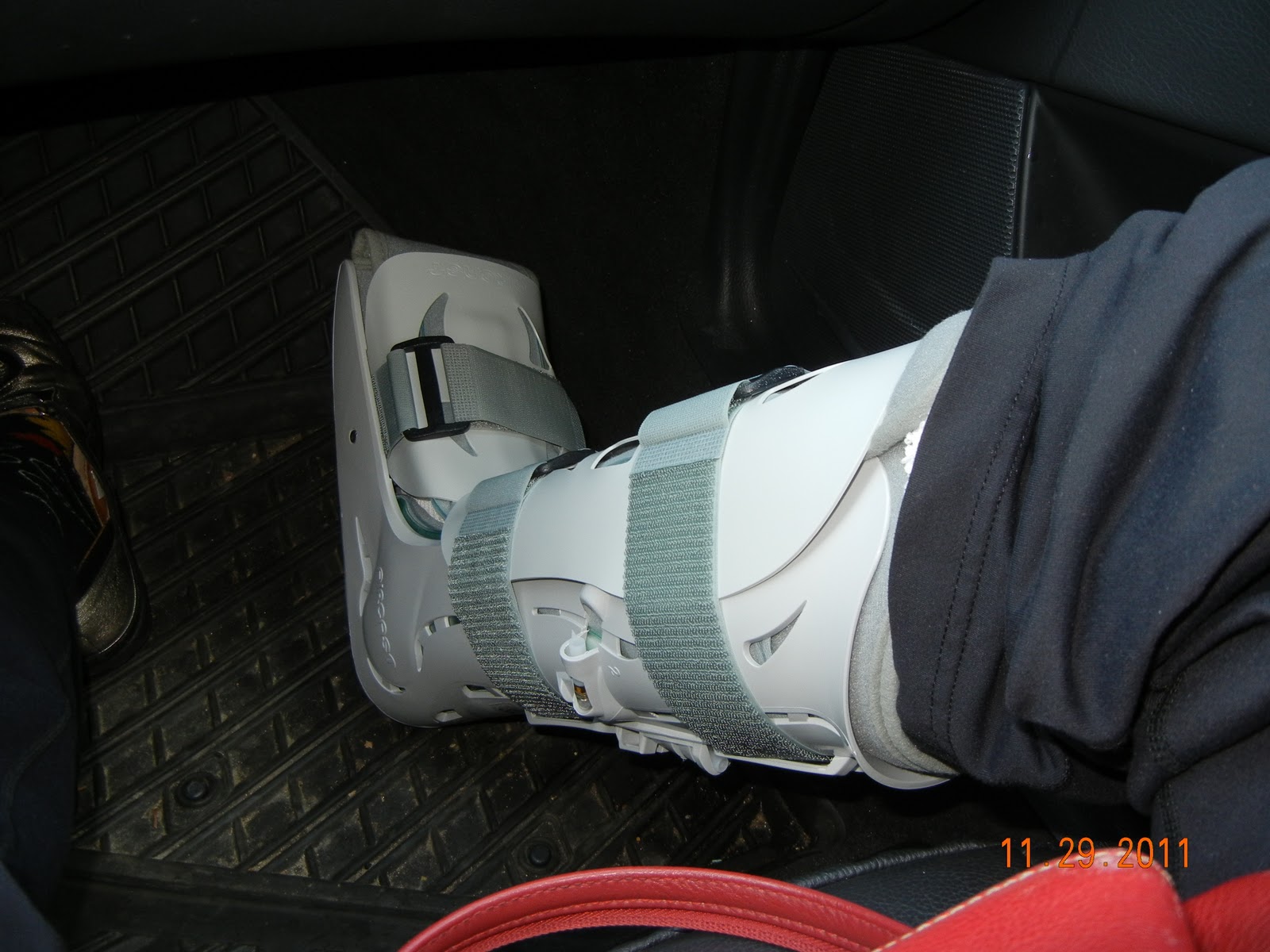 Downs Bunion Surgery 11.17.2011 Hallux Valgus Deformity with Metatarsal ...