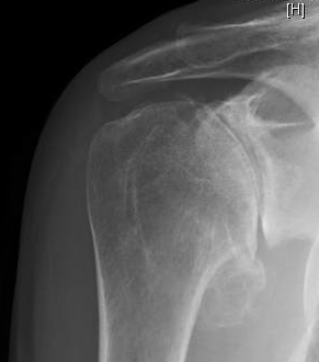 Shoulder Arthritis / Rotator Cuff Tears / Shoulder Pain : Ream and Run ...