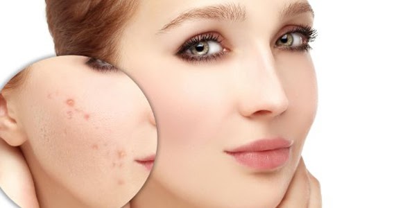 7 Cara Menghilangkan Bekas Bisul Secara Alami - Cara Membuat Masker ...