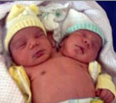 Bisarbeat: Healthy Two-Headed Baby Born in Brazil