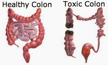 Wellness Lab Health Info: Understanding Colorectal Cancer