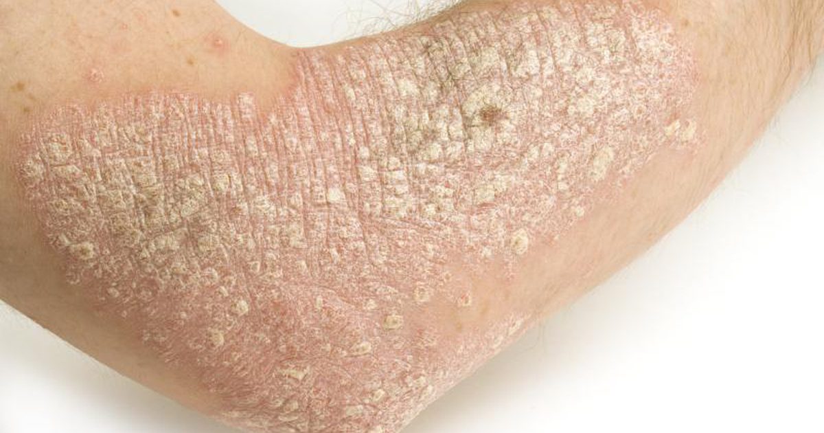 Salep Eksim Kering dan Basah yang Bagus juga Ampuh - Obat untuk ...