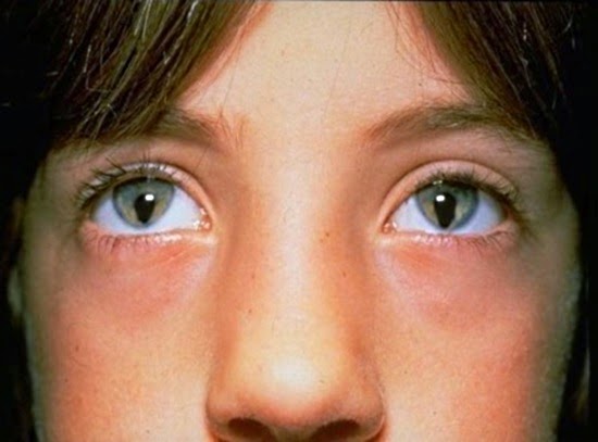 Adalmira Lense : Coloboma: Síndrome genética do Olho de Gato também ...