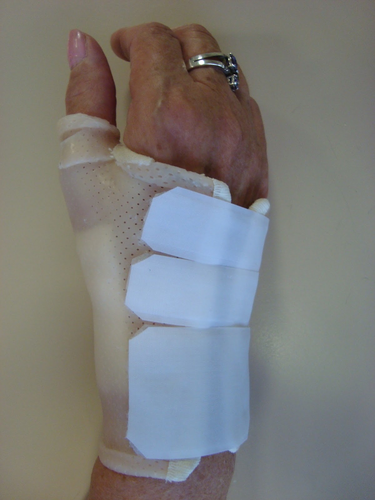 Orthèses sur mesure et appareillage personnalisé main poignet doigts ...