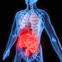 Ülseratif Kolit: Ülseratif Kolit Cerrahi