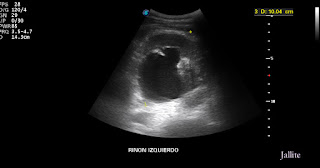 Absceso & Hidronefrosis Renal