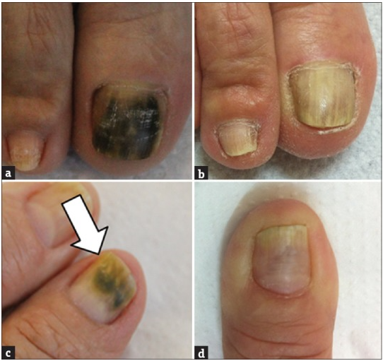 Apitherapy News: Propolis Extract Cures Fungal Nail Infections ...