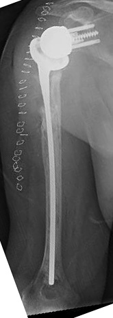 Shoulder Arthritis / Rotator Cuff Tears / Shoulder Pain : Long stem ...