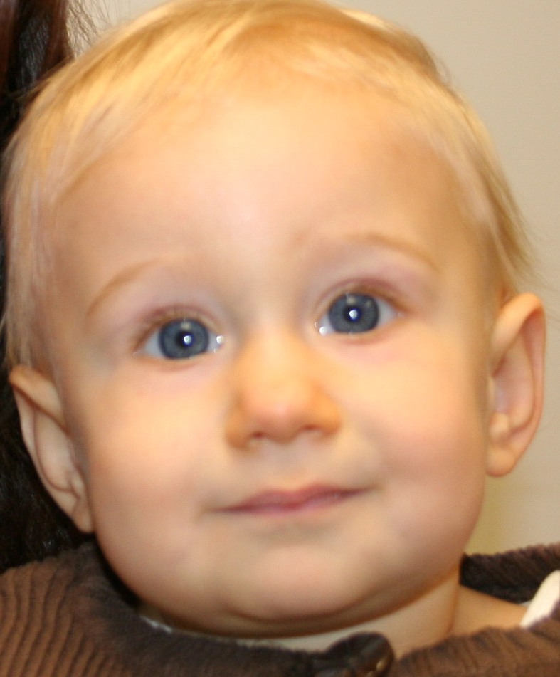 VITAMIN: What is carotenemia?