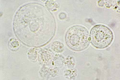 [Haematology] Microscopic Examination of Urinary Sediment - Cells ...