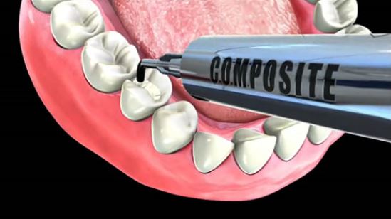 Epiphany: Tideglusib, Repairing Dental Cavities, Wnt signaling, GSK-3 ...