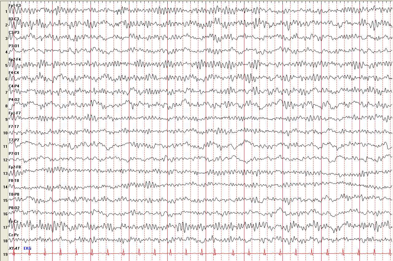 Técnicas de Neuromarketing (III): EEG - Brain and Marketing