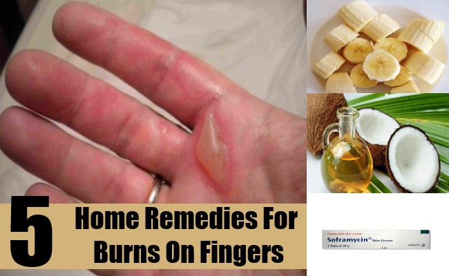 5 Home Remedies for Burns - Natural Beauty Skin Club
