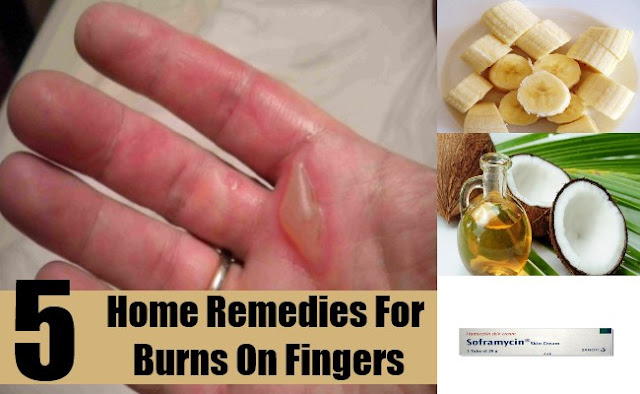 5 Home Remedies for Burns