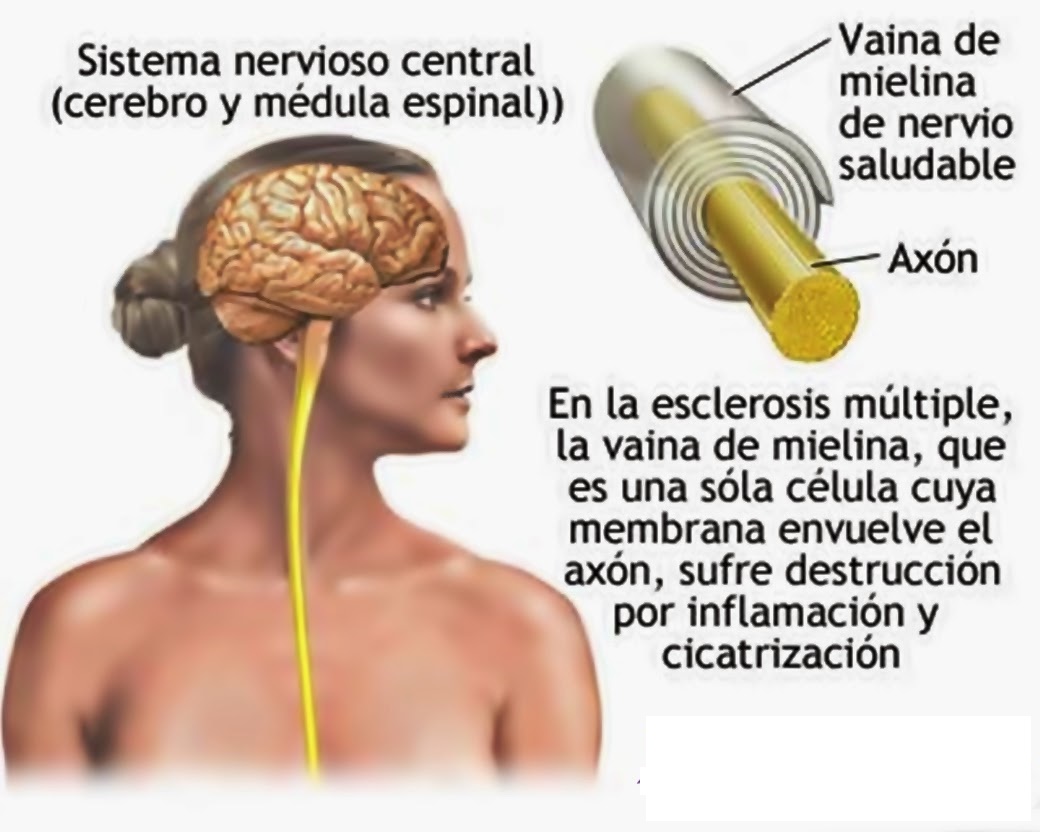ESCLEROSIS MULTIPLE :que es y como tratarla « YOUNGEVITY COLOMBIA