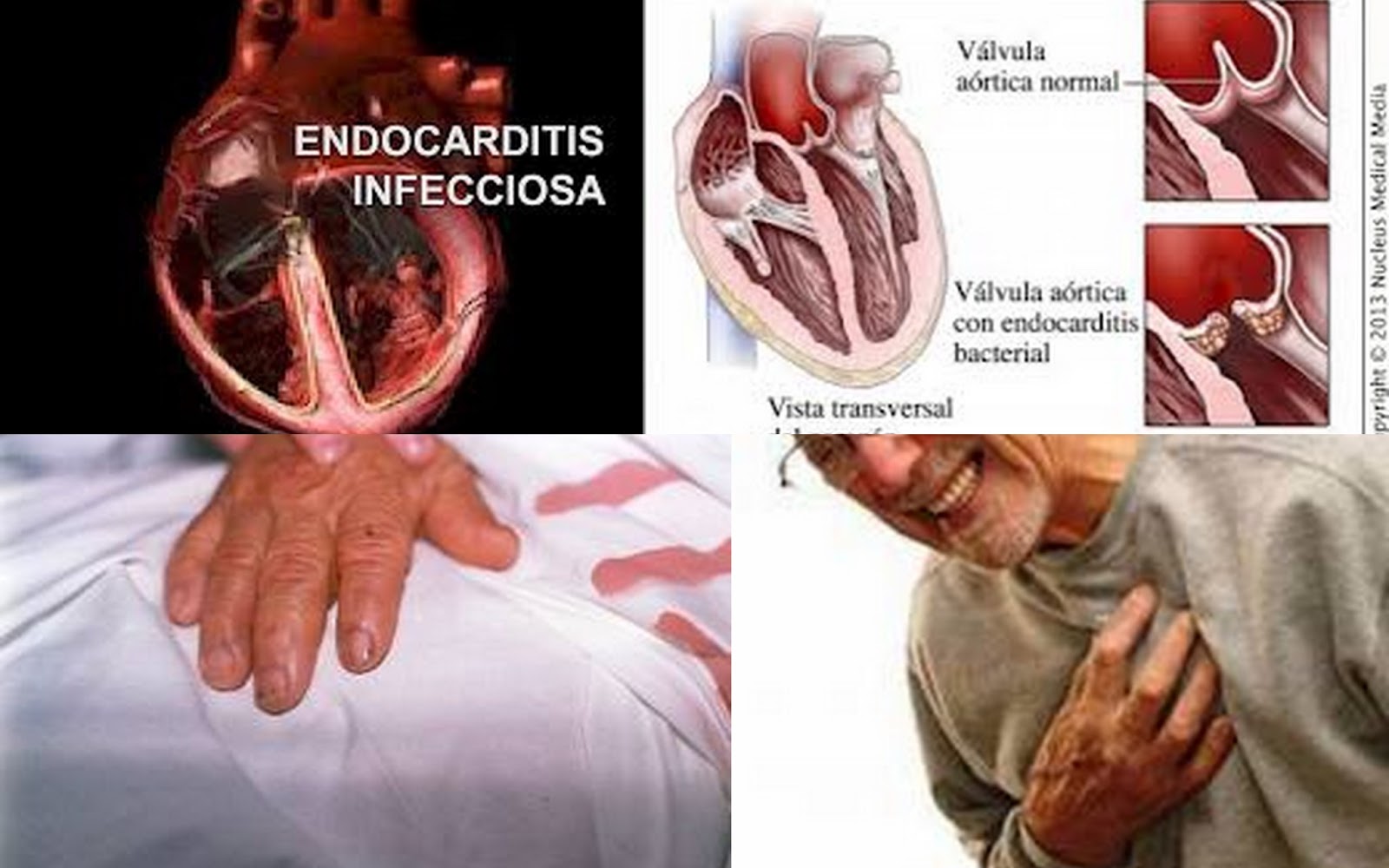 jaitt odonto social: LA ENDOCARDITIS INFECCIOSA EN ODONTOLOGIA