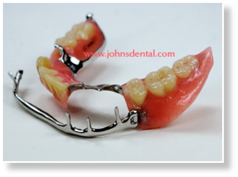 Conectores mayores en protesis parcial removible