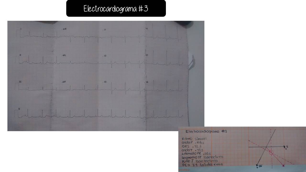 FISIOLOGÍA BÁSICA: Electrocardiograma (Interpretación, Eje Eléctrico)