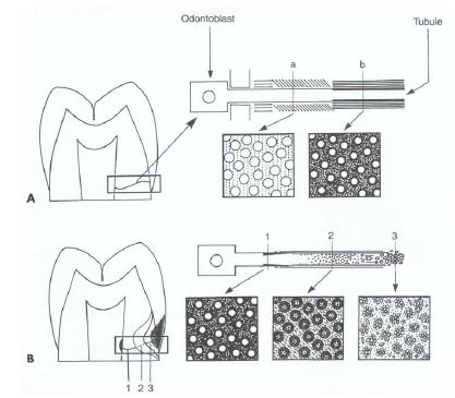 Histopatologi Karies Dentin | Logbook Calon DRG