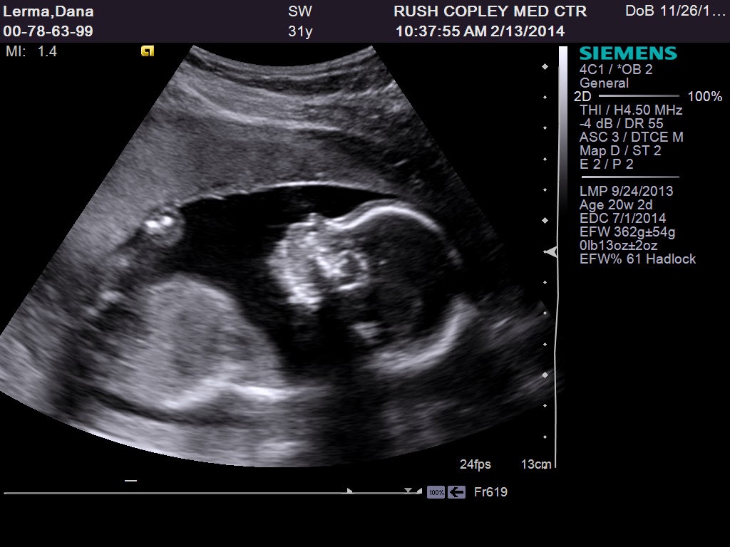 Little Lermas 20 Week Anatomy Scan Little Lermas 20 Week Anatomy Scan