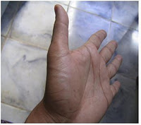 Menganalisis Penyakit dari Diagnosa Telapak Tangan ~ Darul Ihsan