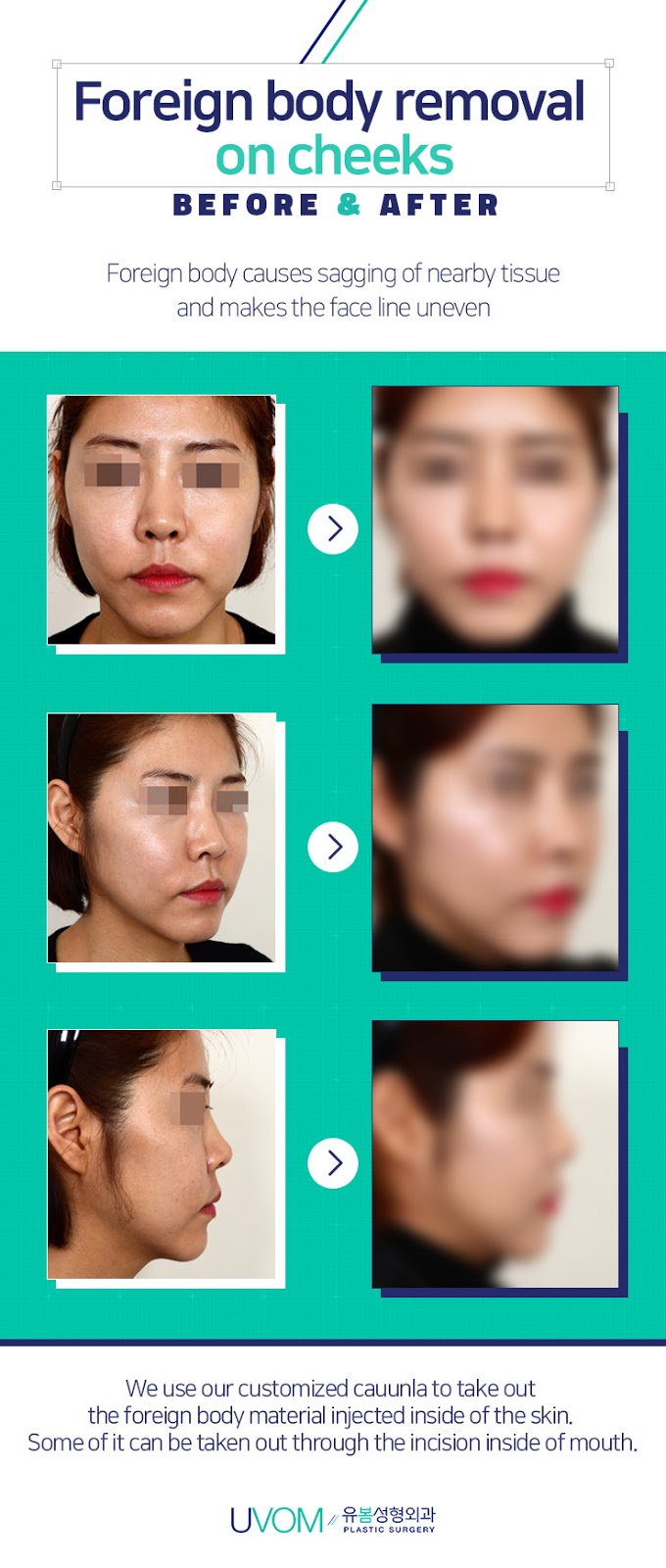 UVOM Plastic Surgery Foreign Body Removal