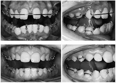 Orthodontic Corner: Twin Block, with or without upper labial bow? Angle ...