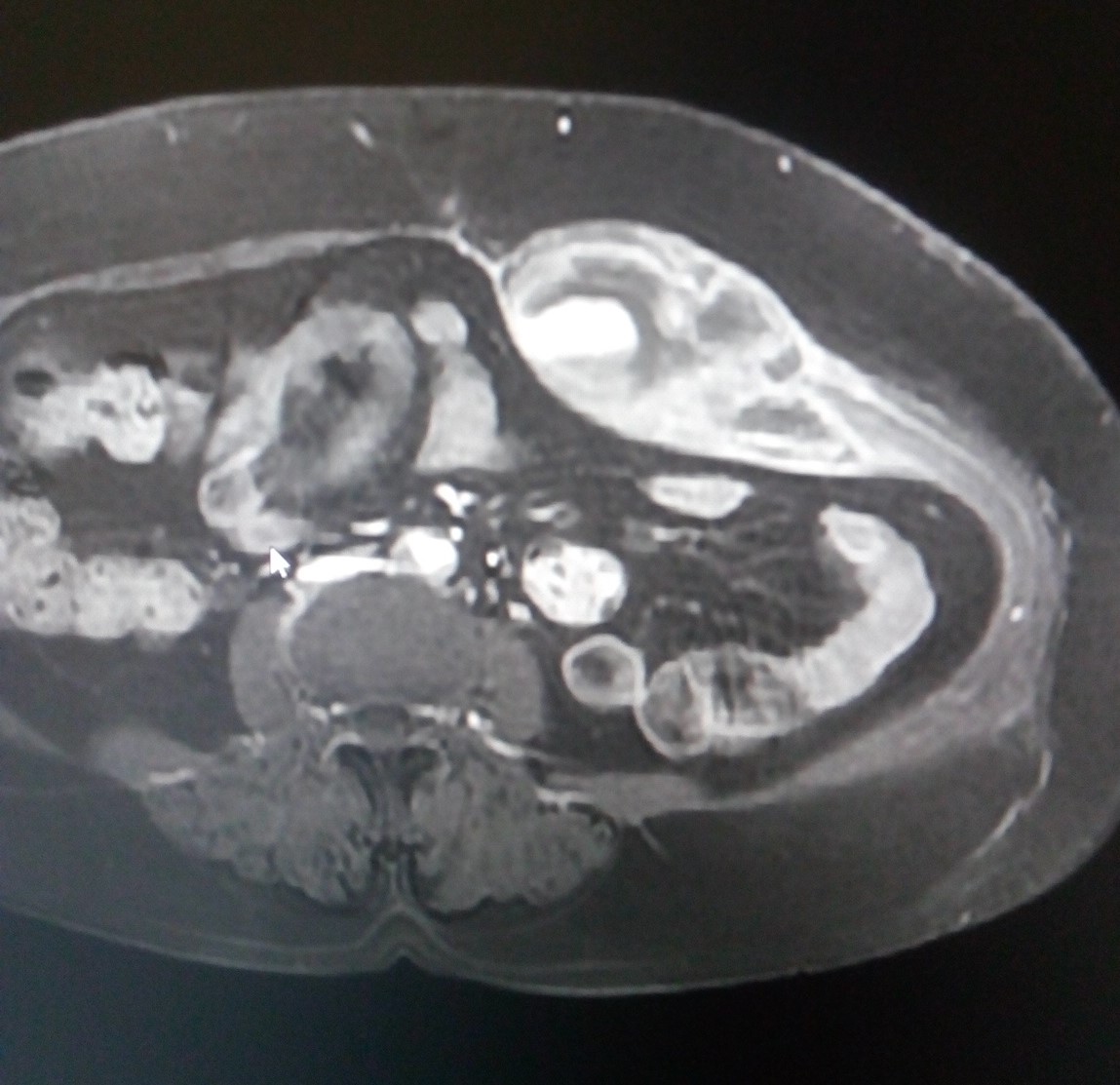 Abdominal wall mass –MRI Approach - Sumer's Radiology Blog