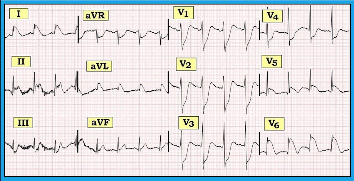 ECG Interpretation: ECG Blog #131 (Acute STEMI – Acute Occlusion of LAD ...
