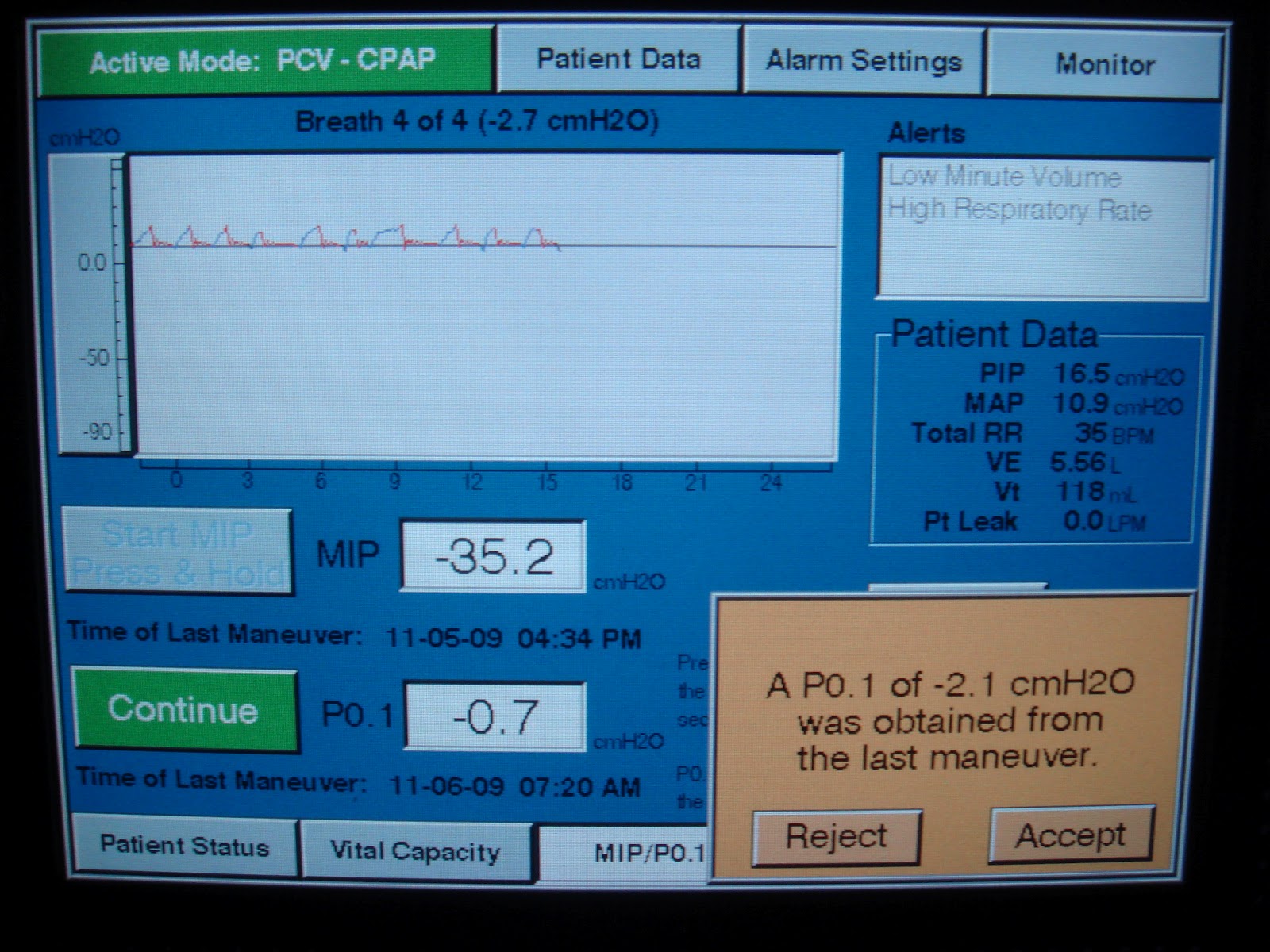 FREMITUS: Obtaining P0.1 on Various Ventilators