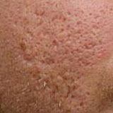 Removes Acne Old Scars, Big Deep Holes, Boxcar acne scars, Icepick acne ...