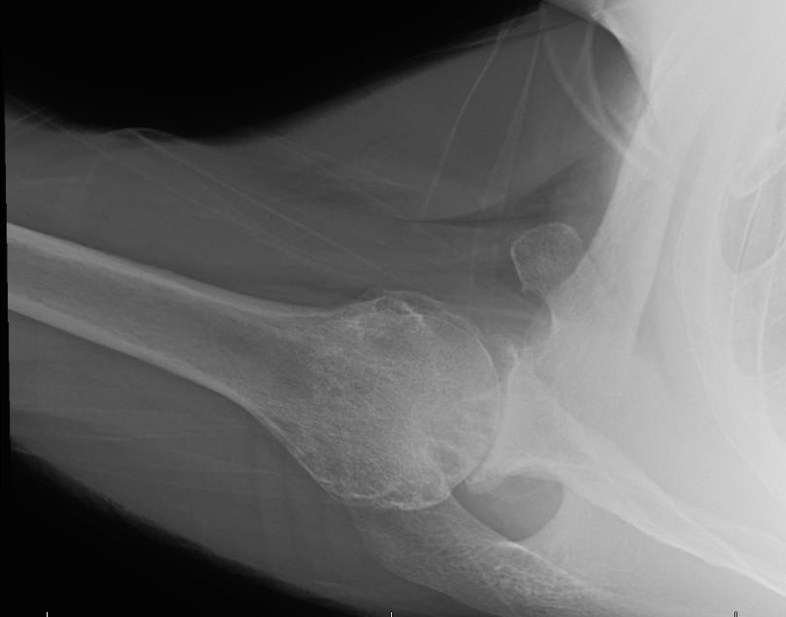 Shoulder and Elbow Surgery: Short stems in anatomic total shoulder ...