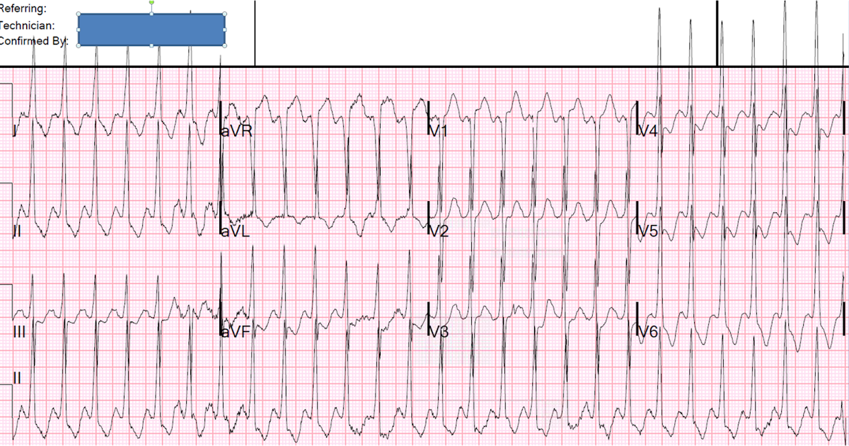 Dr. Smith's ECG Blog: History of Hypertrophic Cardiomyopathy (HOCM ...