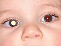 An Introduction to InfantSEE - Eyedolatry