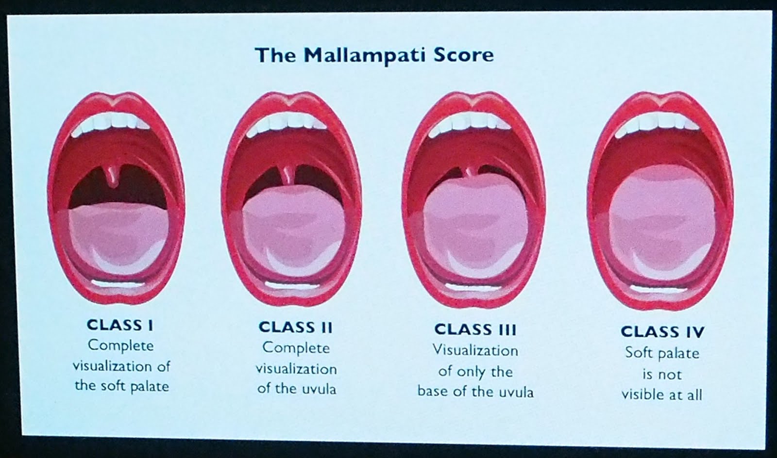 Best Restaurant To Eat - Malaysian Food Blog: Snoring Solution ...