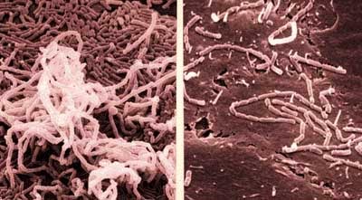 CHANCROID (SOFT CHANCRE, ULCUS MOLLE): CAUSES, LOCATION AND ...