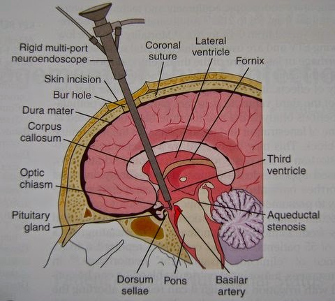 Brain & Mind - A to Z: Role of Endoscopic Third Ventriculostomy ( ETV ...