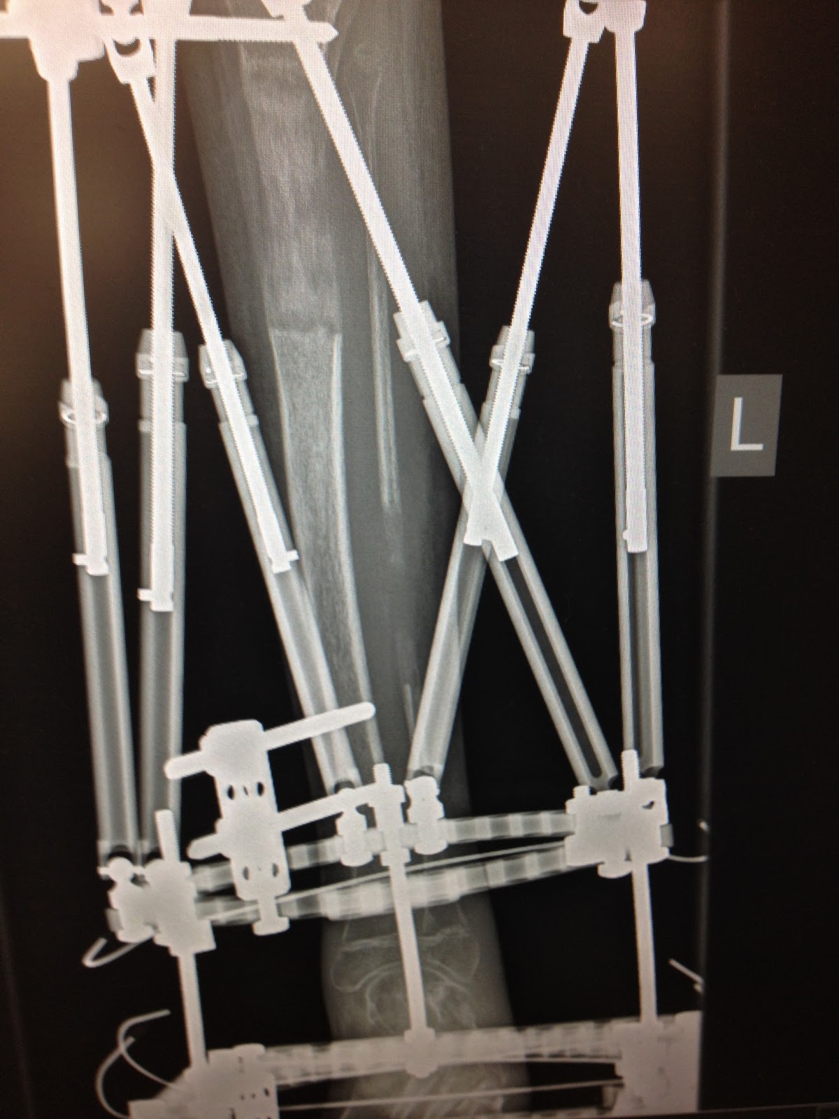 fibular hemimelia leg lengthening: Bowed Tibia: turning struts again